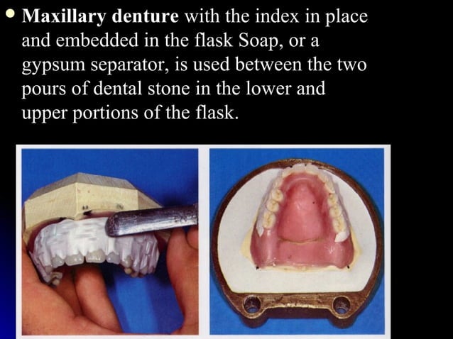 03 01 01_45-(flasking and processing complete denture) | PPT | Dental ...