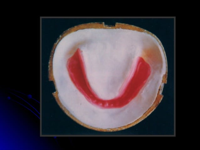 03 01 01_45-(flasking and processing complete denture) | PPT | Dental ...