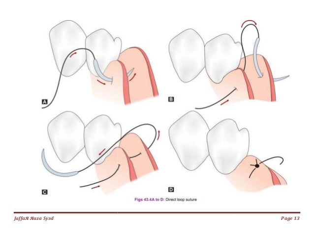 032. periodontal surgery
