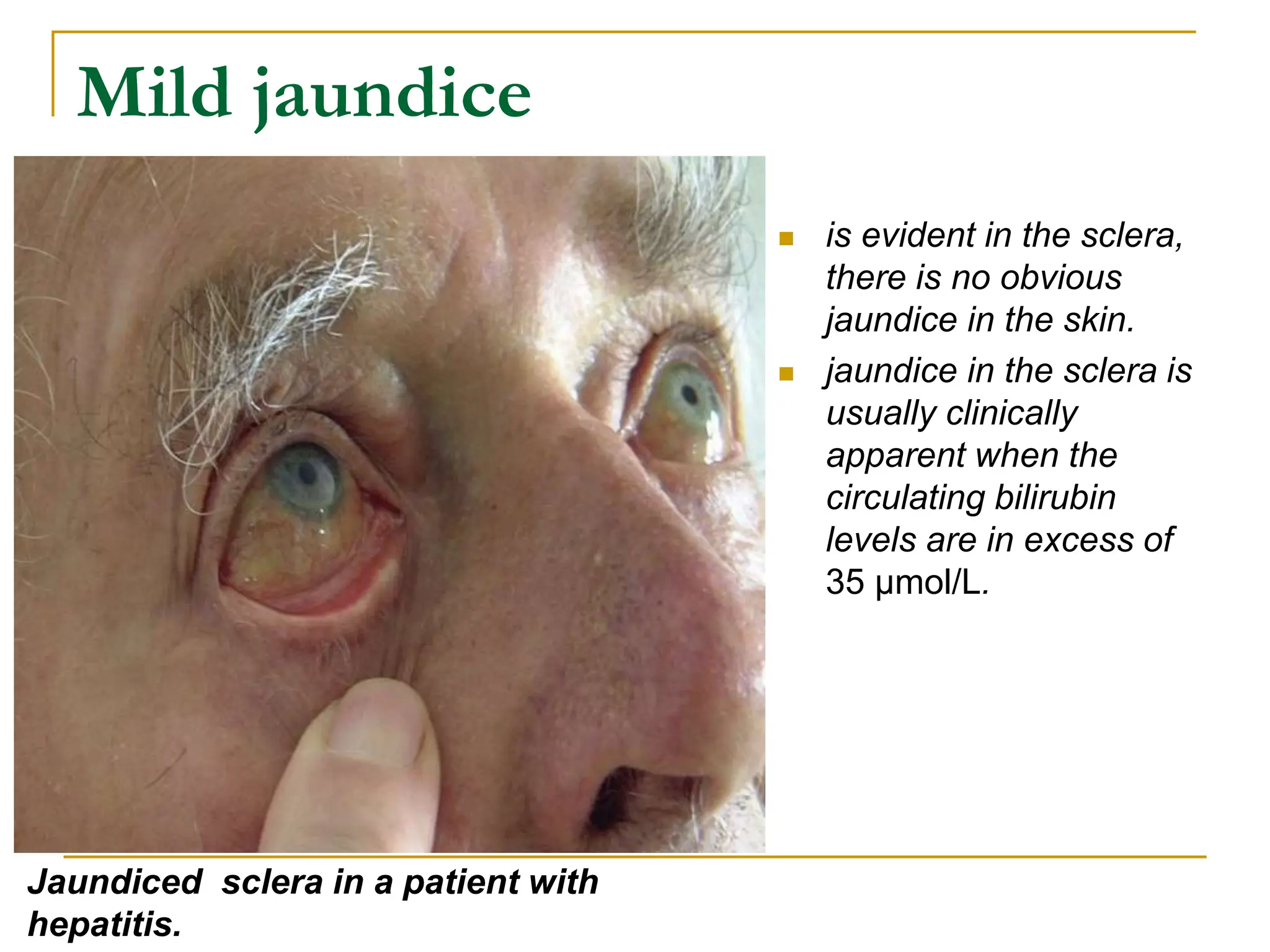03251163_jaundice_asc_port_hypertension.pptx
