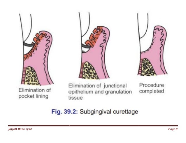 gingival curettage