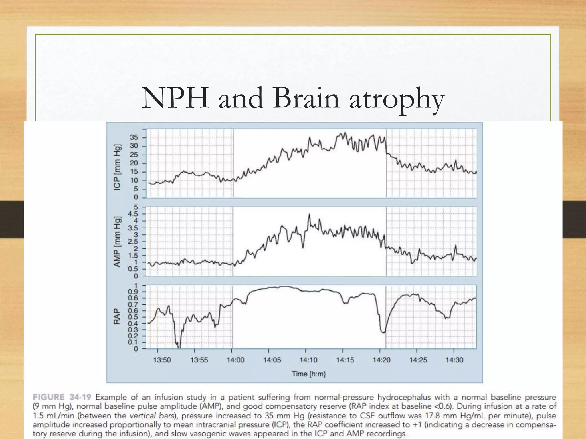 034 Clinical evaluation of adult hydrocephalus | PPTX
