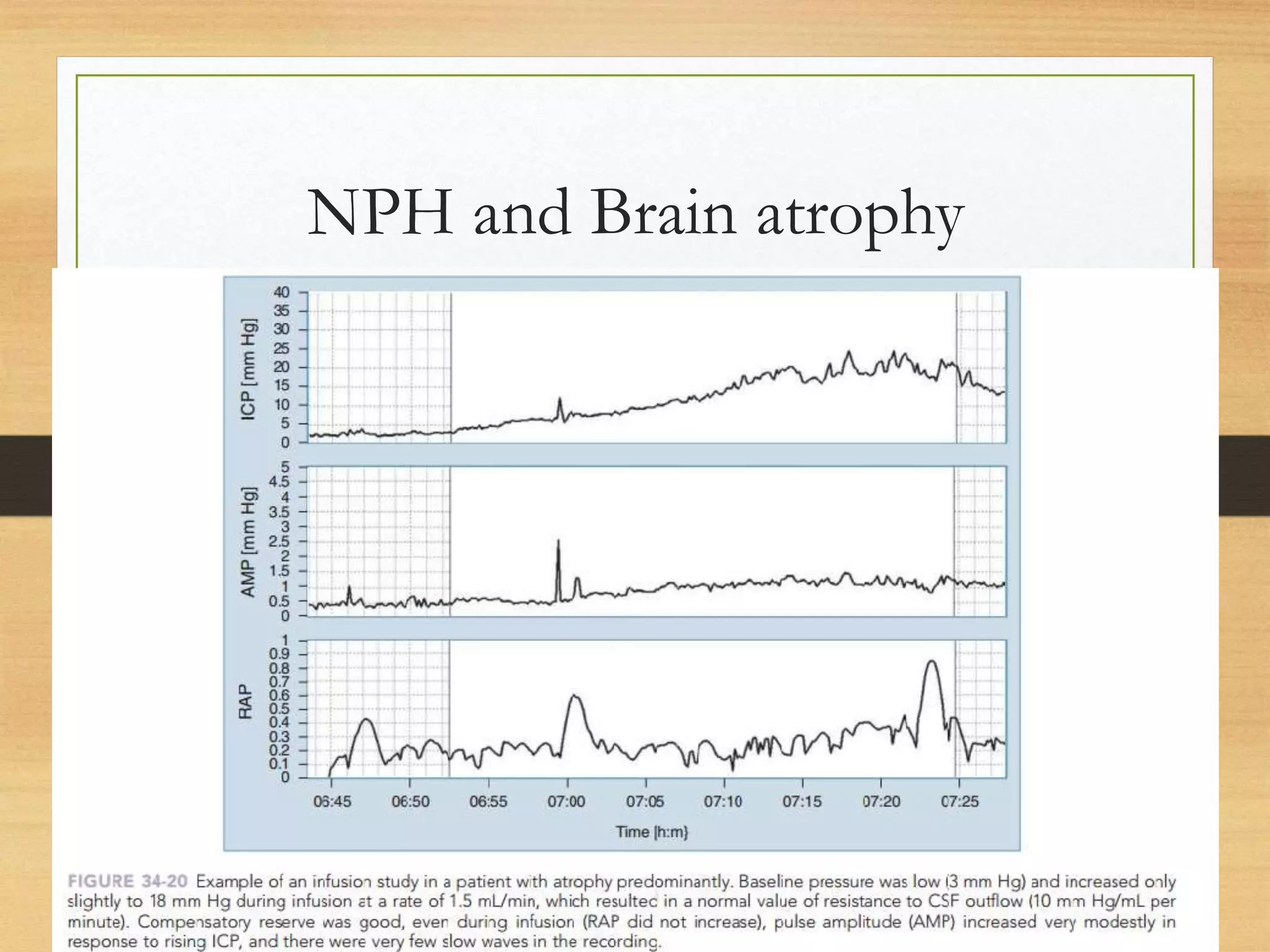 034 Clinical evaluation of adult hydrocephalus | PPTX