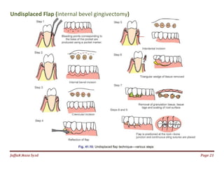 035. periodontal flap | PDF