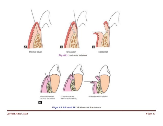 035. periodontal flap