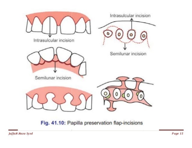 035. periodontal flap