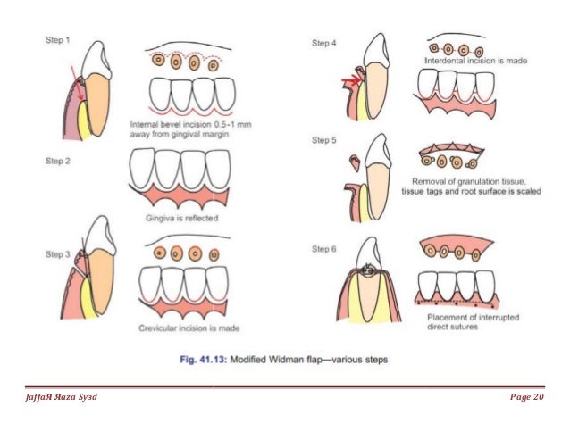 035. periodontal flap