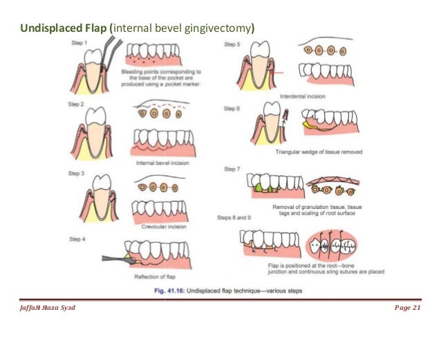 035. periodontal flap