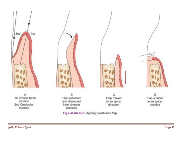 035. periodontal flap