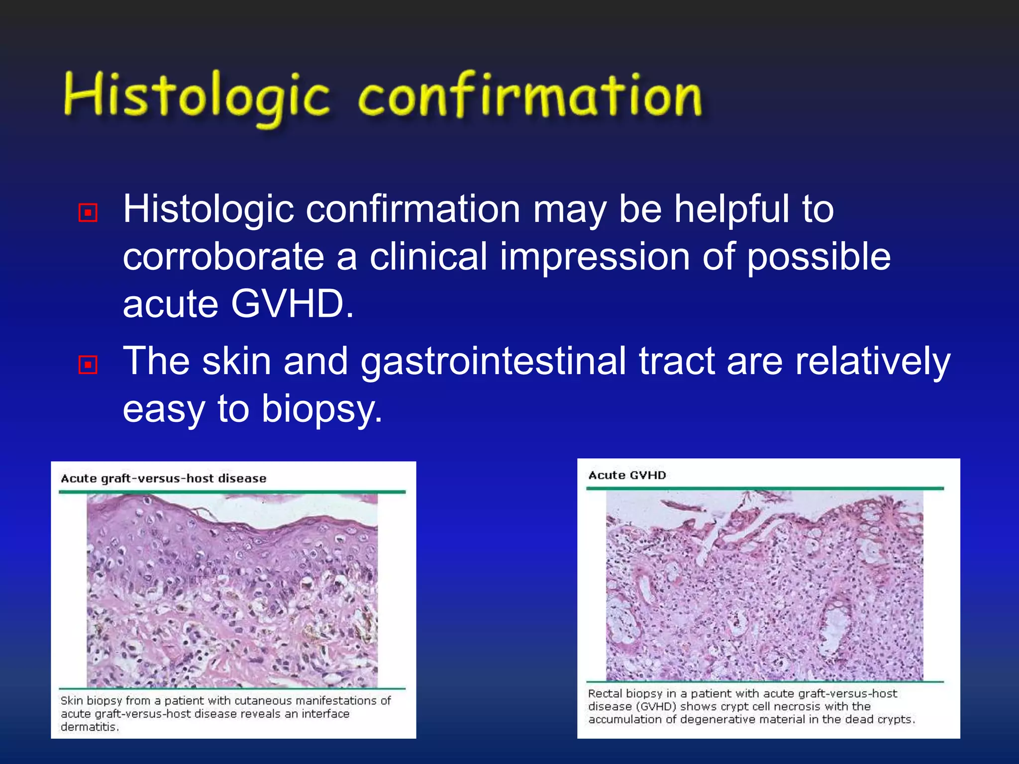 Graft Versus Host Disease | PPTX