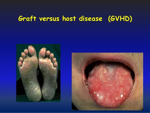 Graft Versus Host Disease