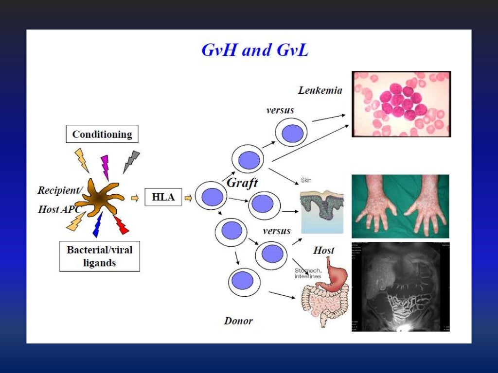 Graft Versus Host Disease