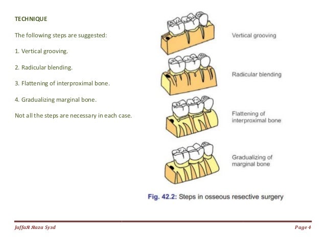 037. osseous surgery