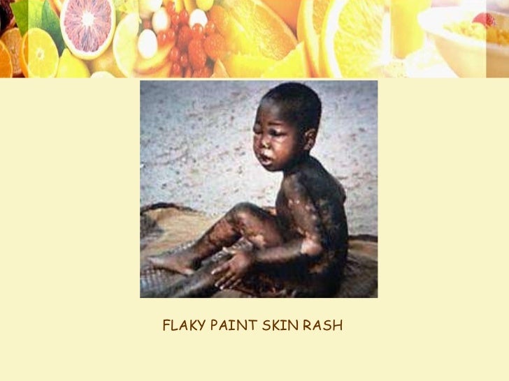 nutrition in children