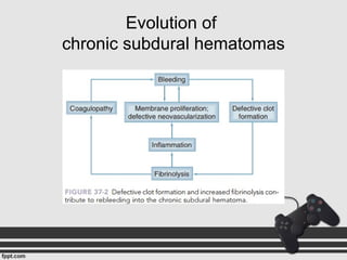 Subdural Hematoma Pathophysiology