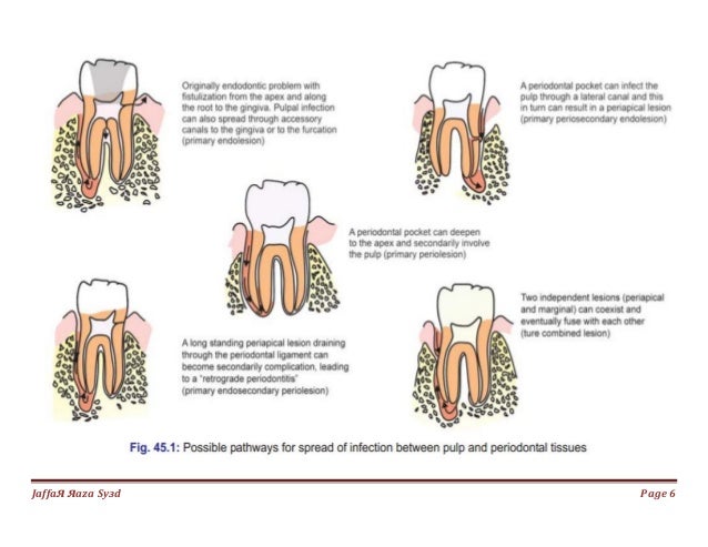 038. endo perio lesions