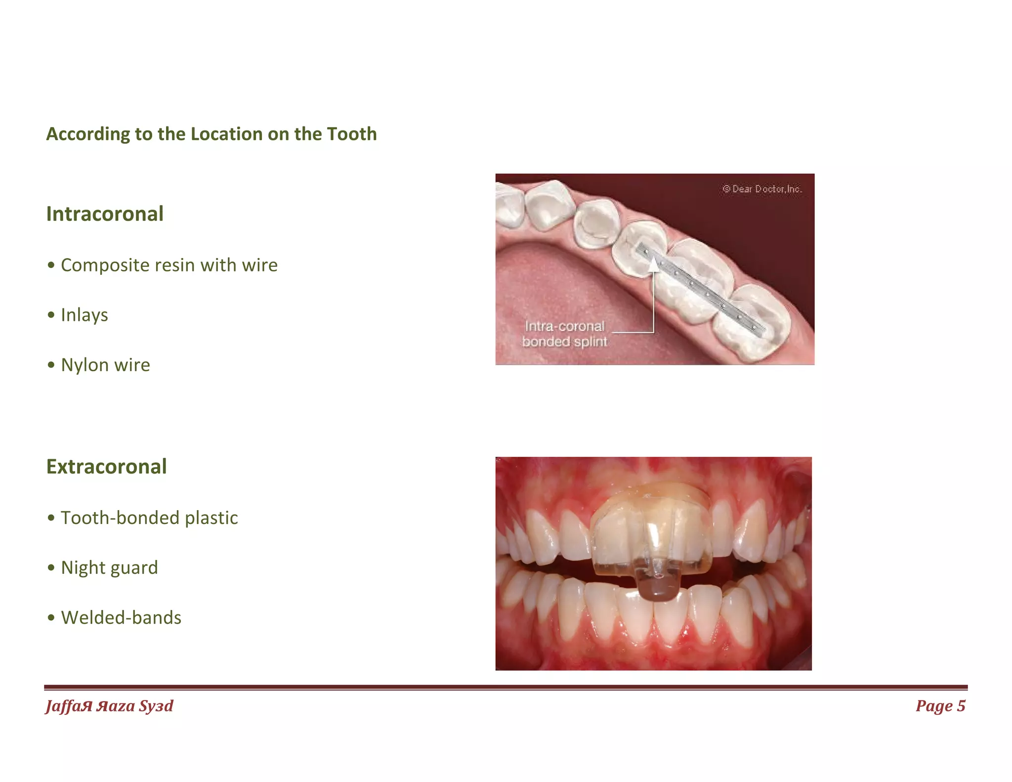 039.splints in periodontal therapy | PDF