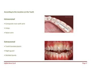 039.splints in periodontal therapy | PDF