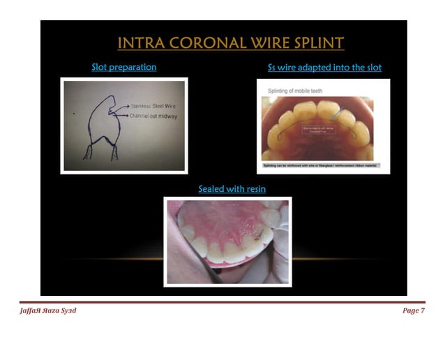 039.splints in periodontal therapy | PDF | Physical Therapy | Wellness
