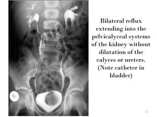 03 Acute pyelonephritis.ppt ppt ppt pptp | PPT