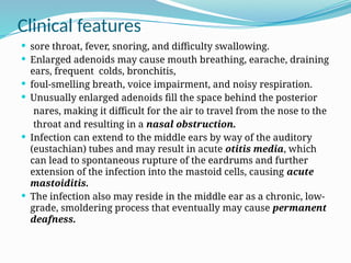 03 adenotonsilitis.pptx 03 adenotonsilitis.pptx