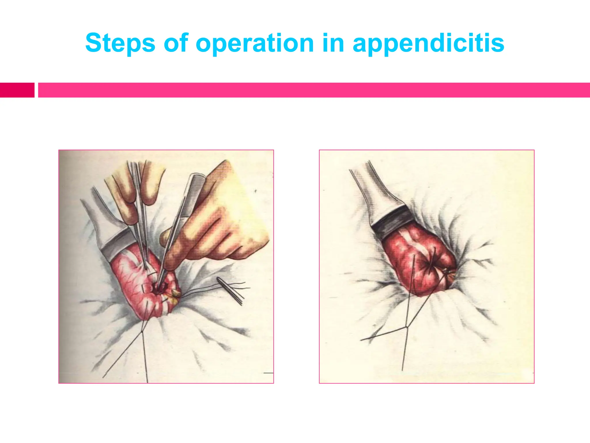 Appendicitis and management in children.ppt