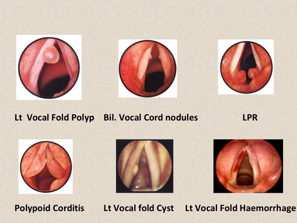 03 benign disease of larynx