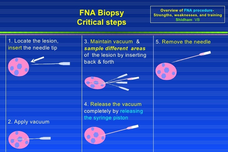 Overview of FNA procedure- S. K. Navale Medical College, Pune, India