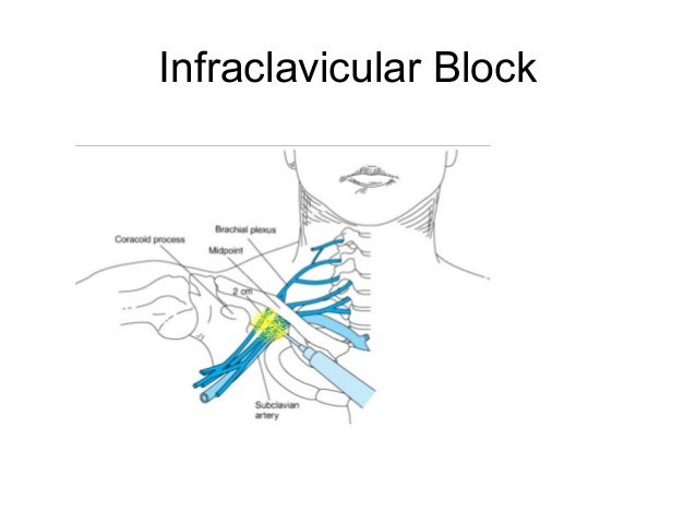 Brachial Plexus Block