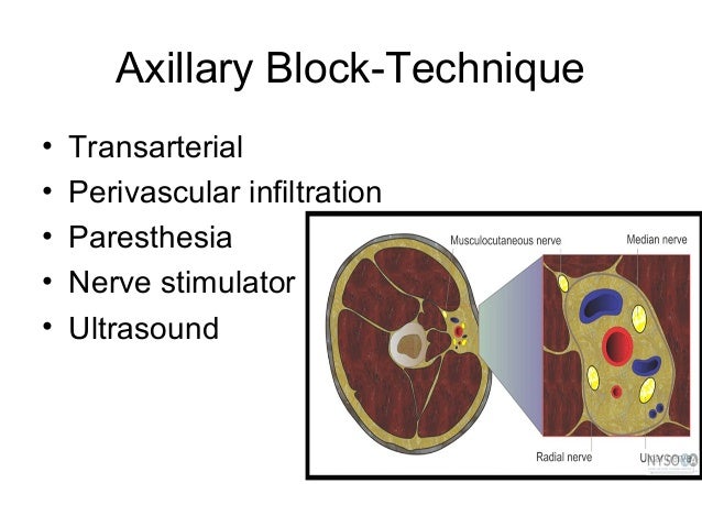 Brachial plexus block