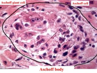 03 cardiac pathology | PPT