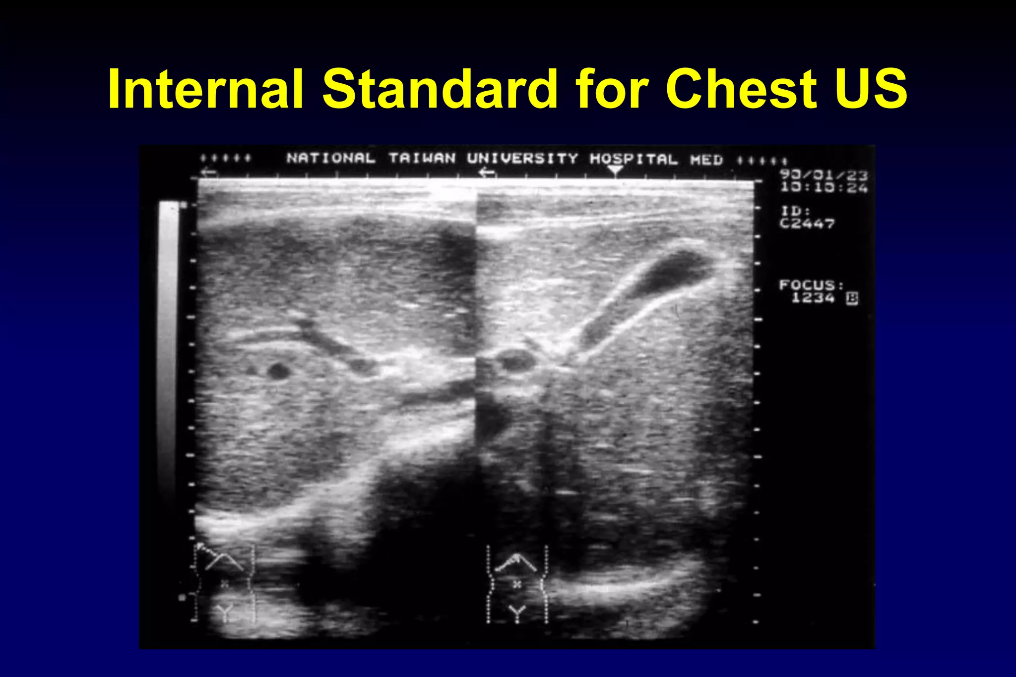 03 chest ultrasound | PDF