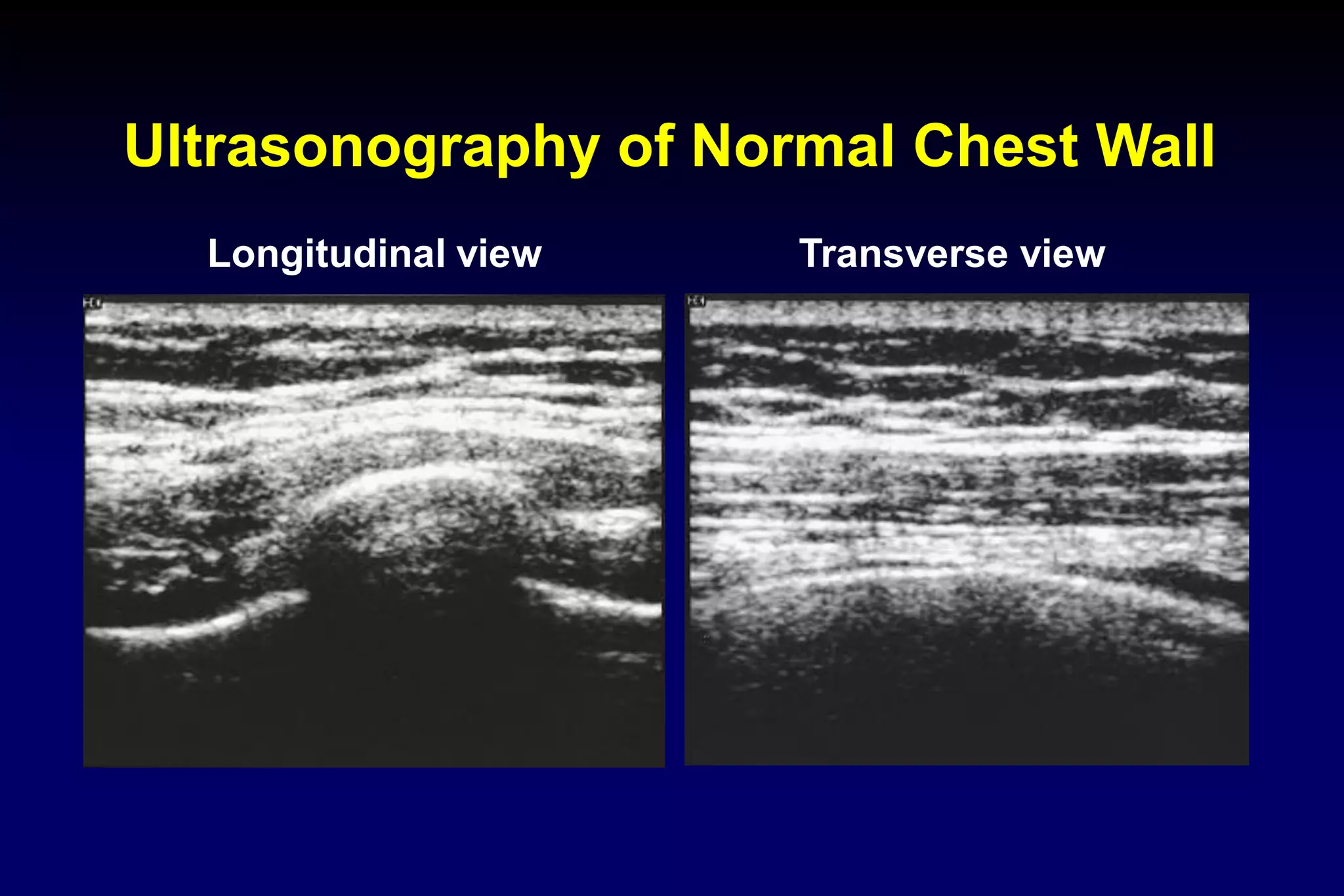 03 chest ultrasound | PDF