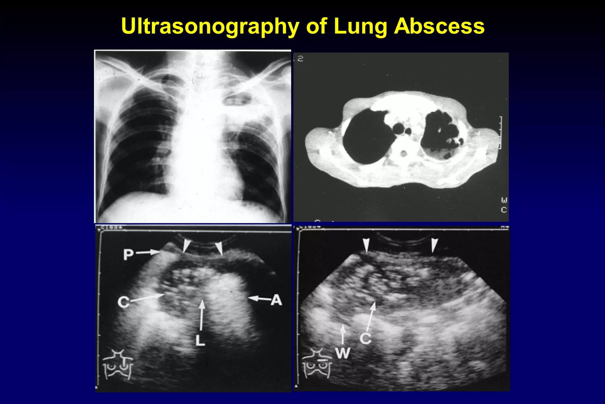 03 chest ultrasound | PPT