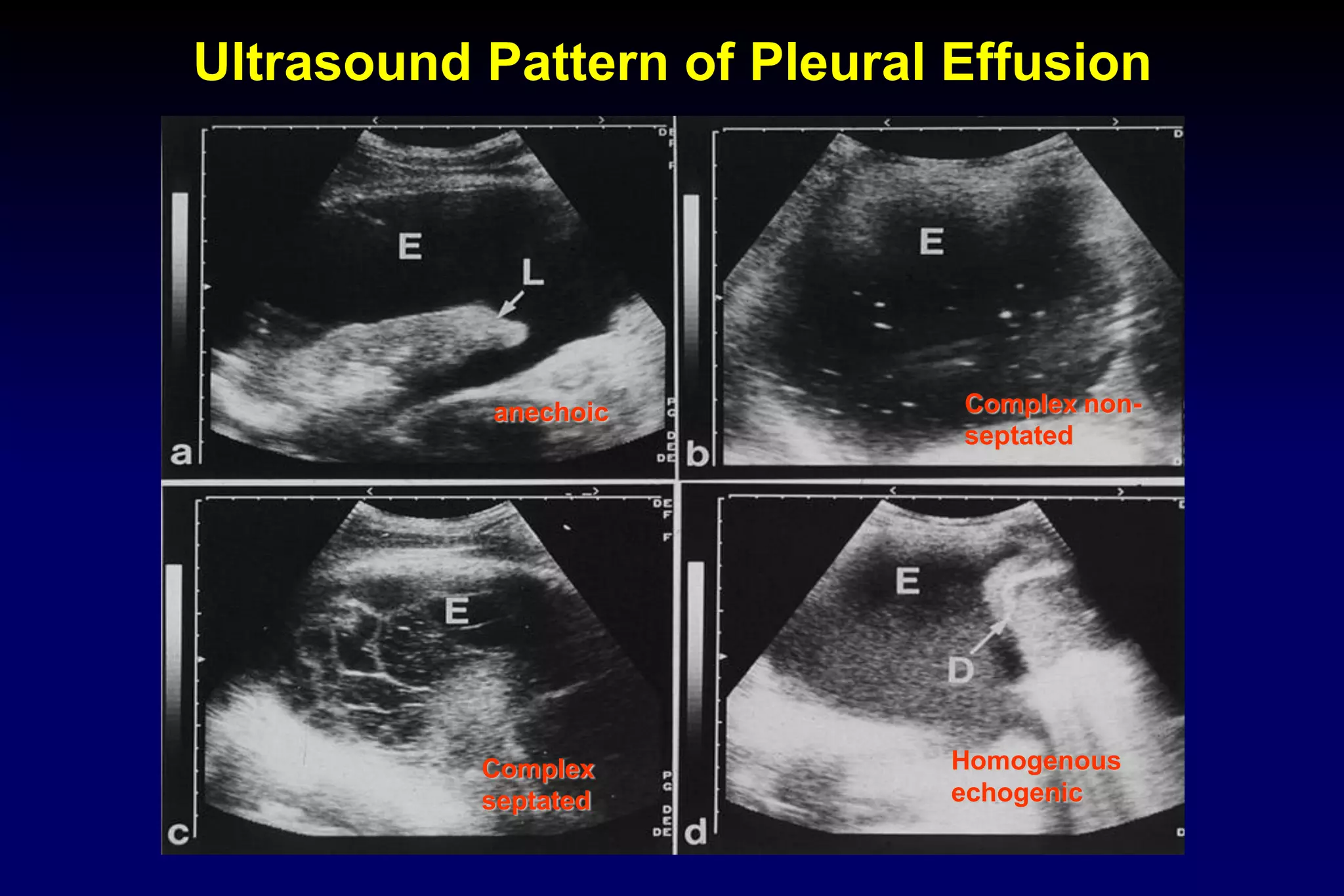 03 chest ultrasound | PDF