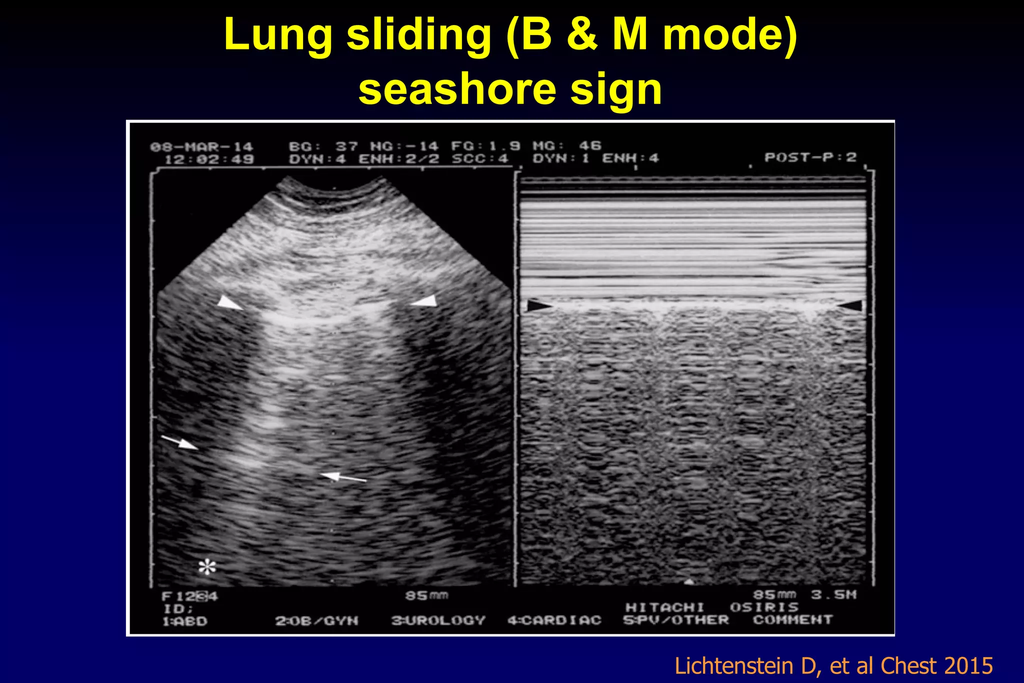 03 chest ultrasound | PPT