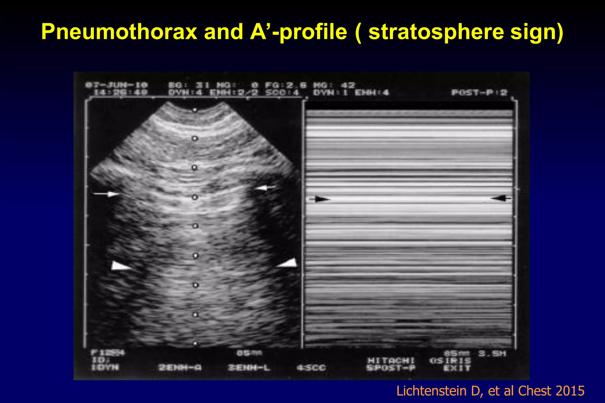 03 chest ultrasound | PPT