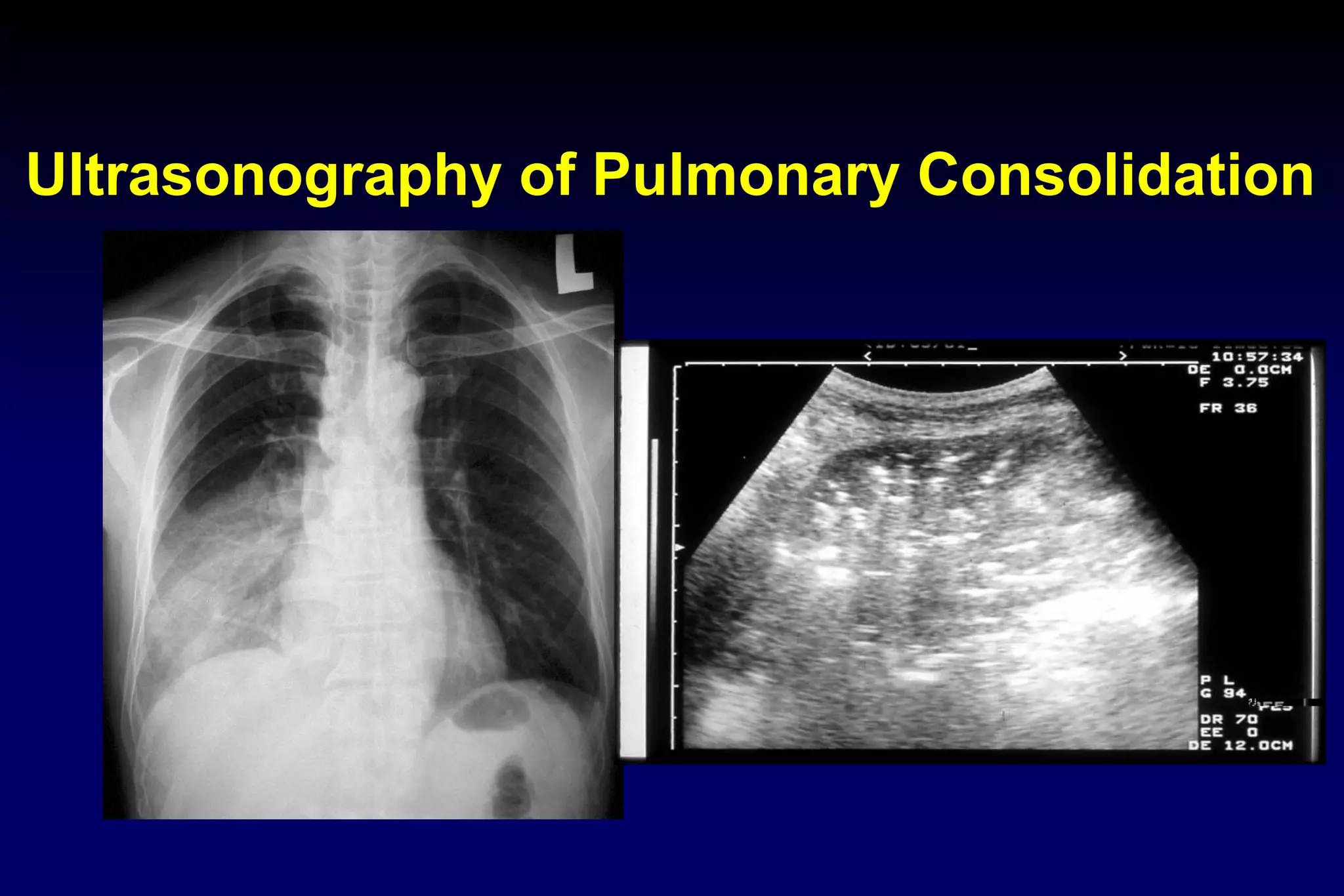 03 chest ultrasound | PDF