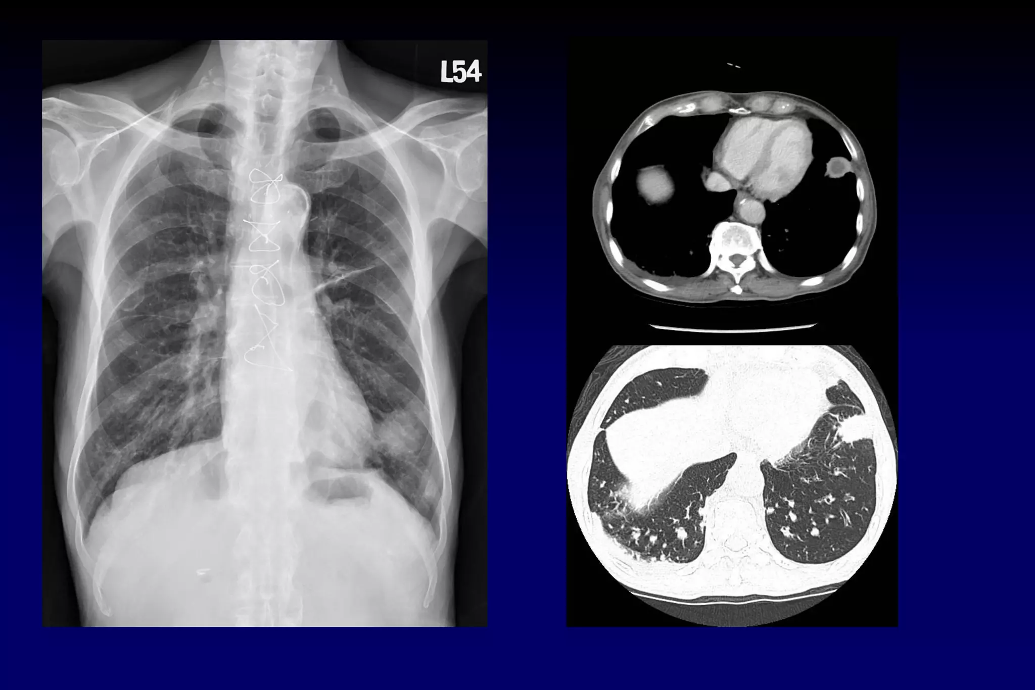 03 chest ultrasound | PPT