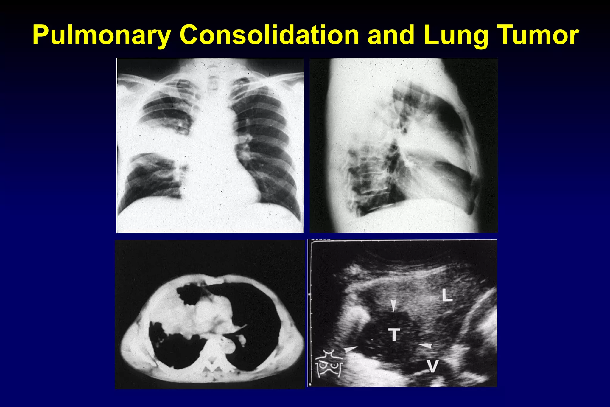 03 chest ultrasound | PPT