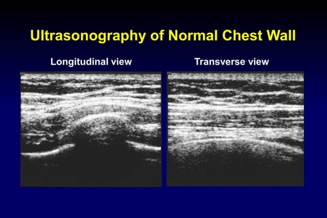 03 chest ultrasound | PPT