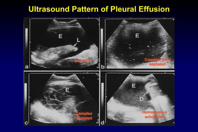 03 chest ultrasound | PPT