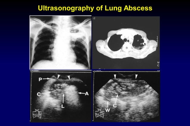 03 chest ultrasound | PPT