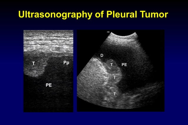 03 chest ultrasound | PPT