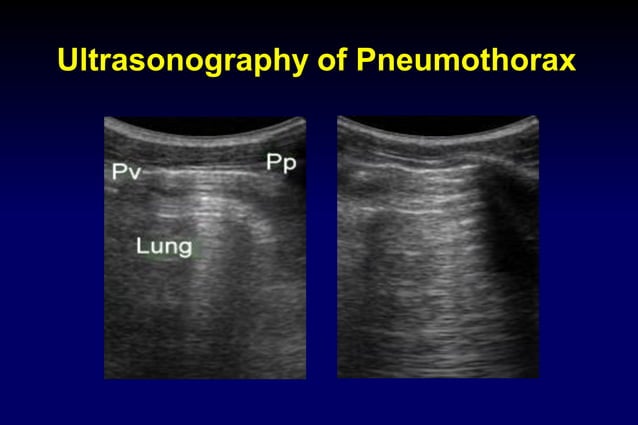 03 chest ultrasound | PPT