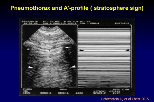 03 chest ultrasound | PPT