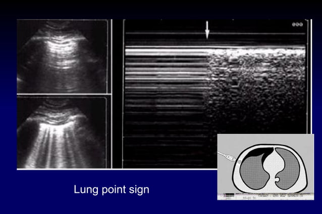 03 chest ultrasound | PPT