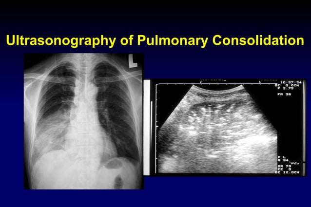 03 chest ultrasound | PPT