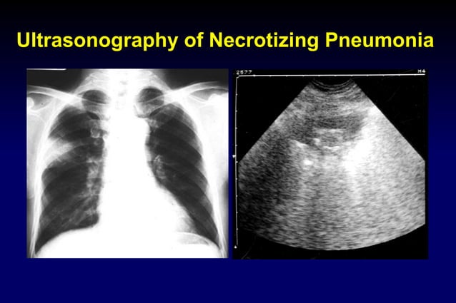 03 chest ultrasound | PPT