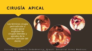 Cirugía Apical paso a paso, procedimiento dental | PPTX